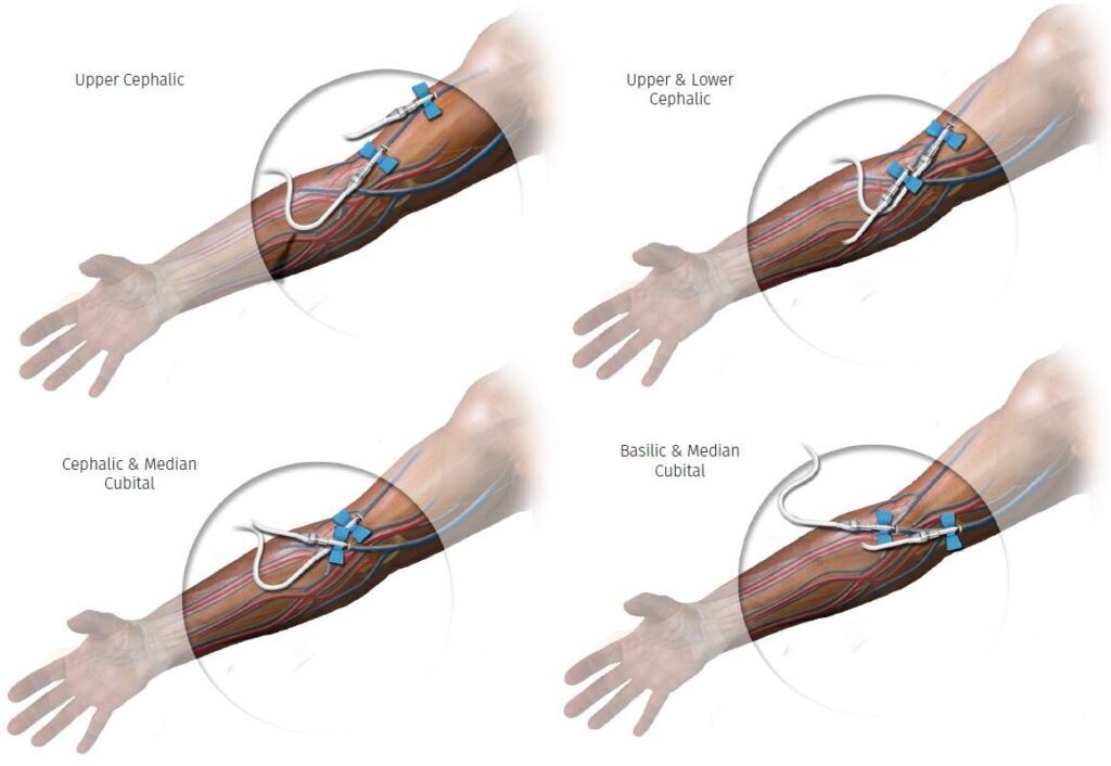 Endovascular AV Fistula Creation and Use – Medical Education Institute